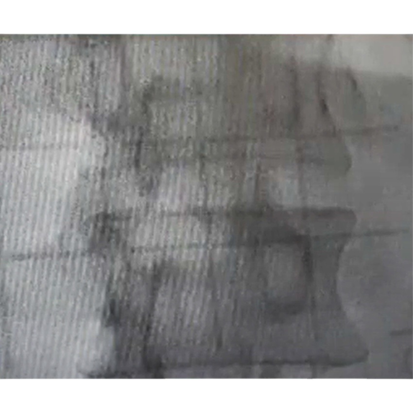 CT Scan of Body Surface Positioning Sticker Puncture Positioning ...